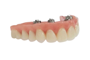 Hybrid Dentures - Next Dental Lab