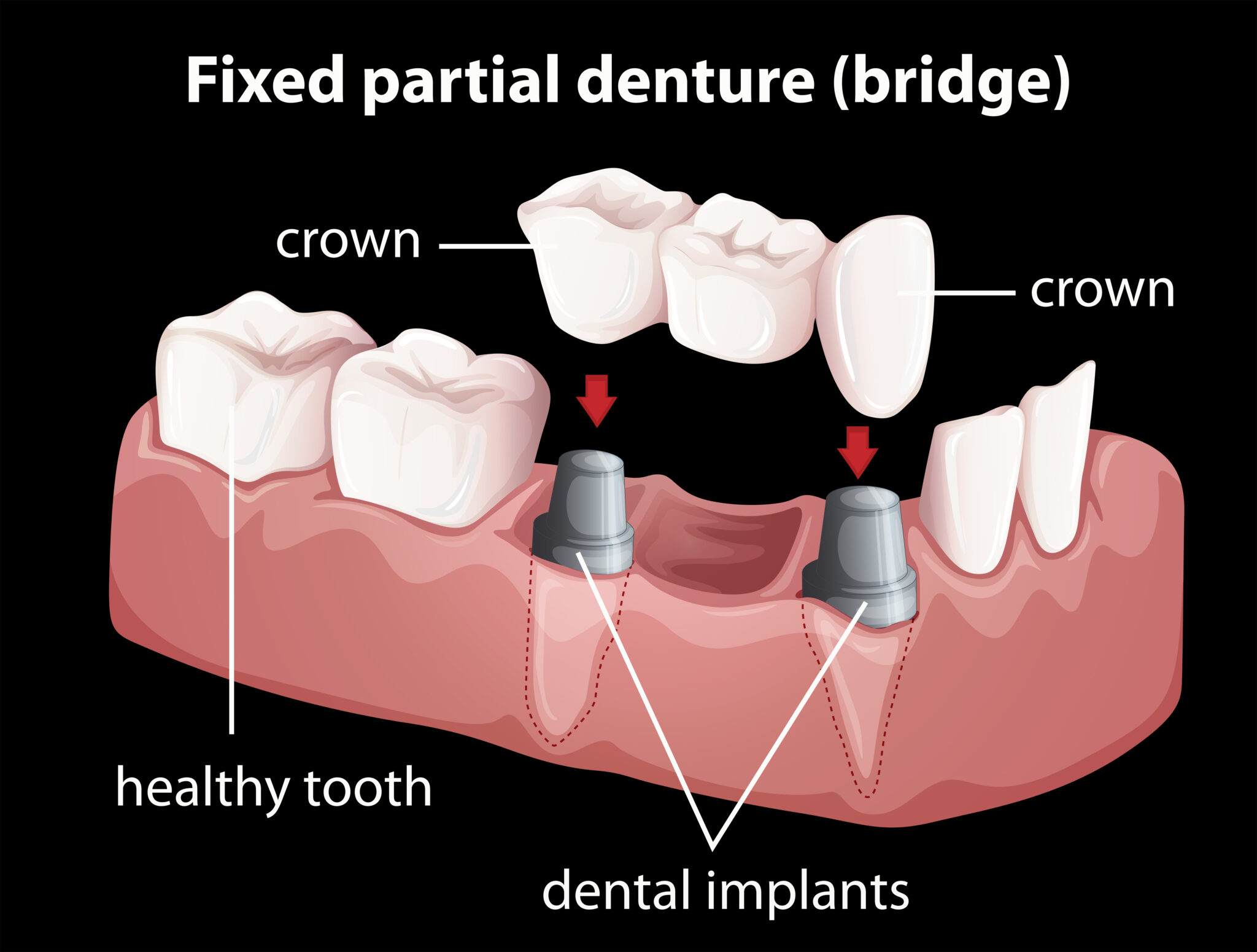 How To Choose The Right Crown And Bridge Material For Your Patient ...
