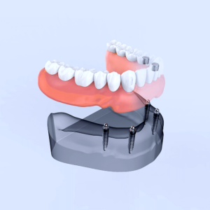 Next Dental Lab | Full-Service Dental Laboratory