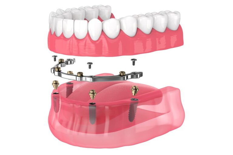 Dental Implant Overdentures: When They’re Best for You