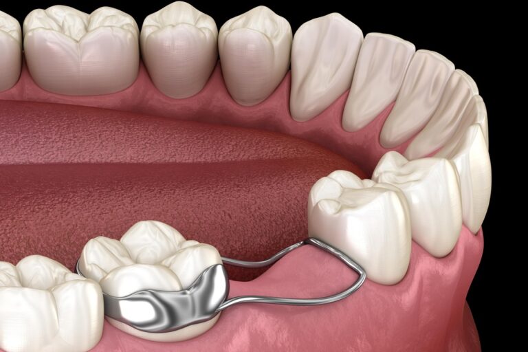 Space Maintainer Types in Dentistry: Complete Guide