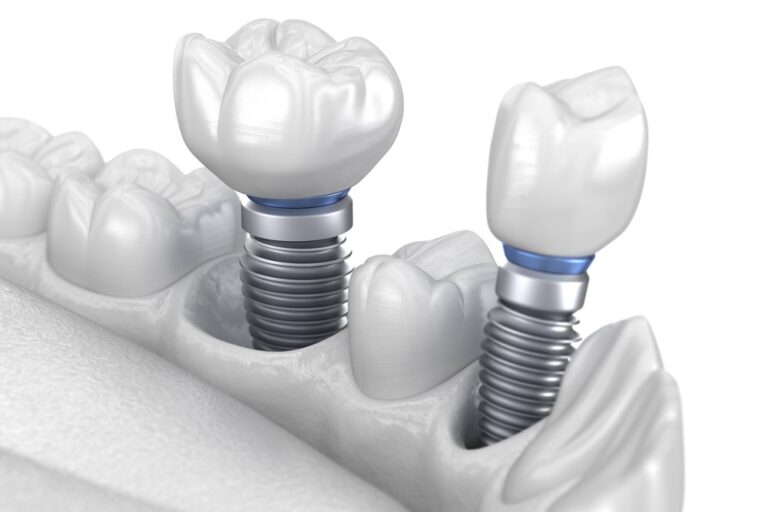 The Role Of Ti-Base Abutments In Dental Implants - Next Dental Lab