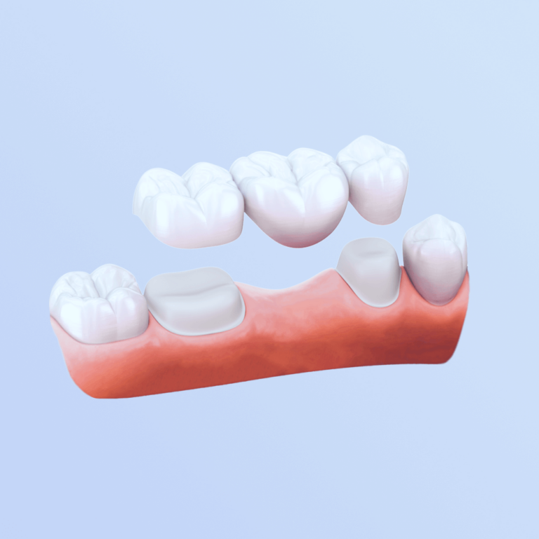 Dental Lab Products - Next Dental Lab