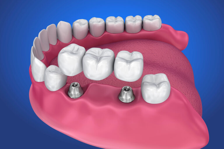 Custom Fits: An Implant-Supported Denture Lab Guide