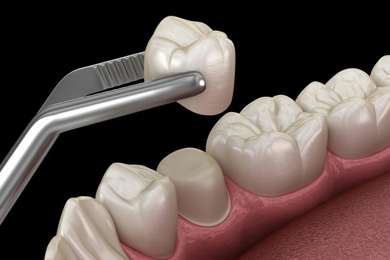 4 Types Of Ceramic Crowns For Your Dental Practice - Next Dental Lab