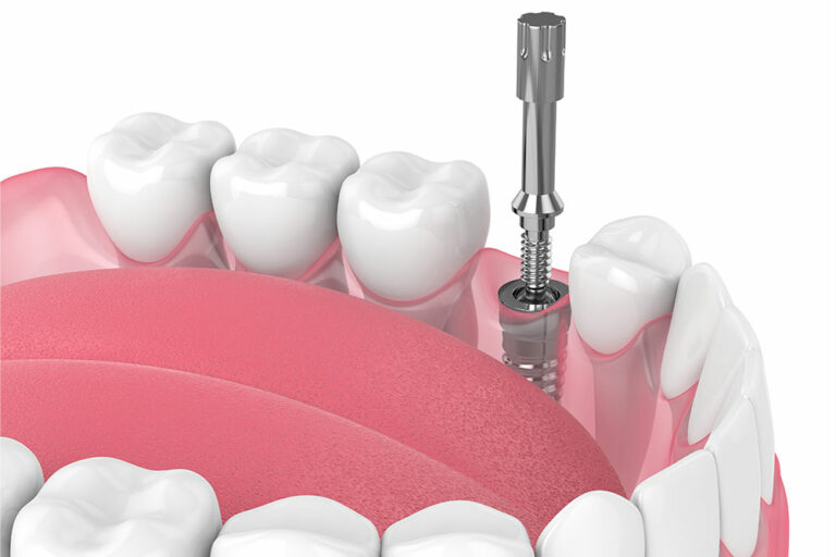 A Guide to Dental Implant Screw Types & Restorations
