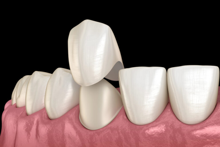 Dental Crown vs. Bonding: Which Is Right for You?